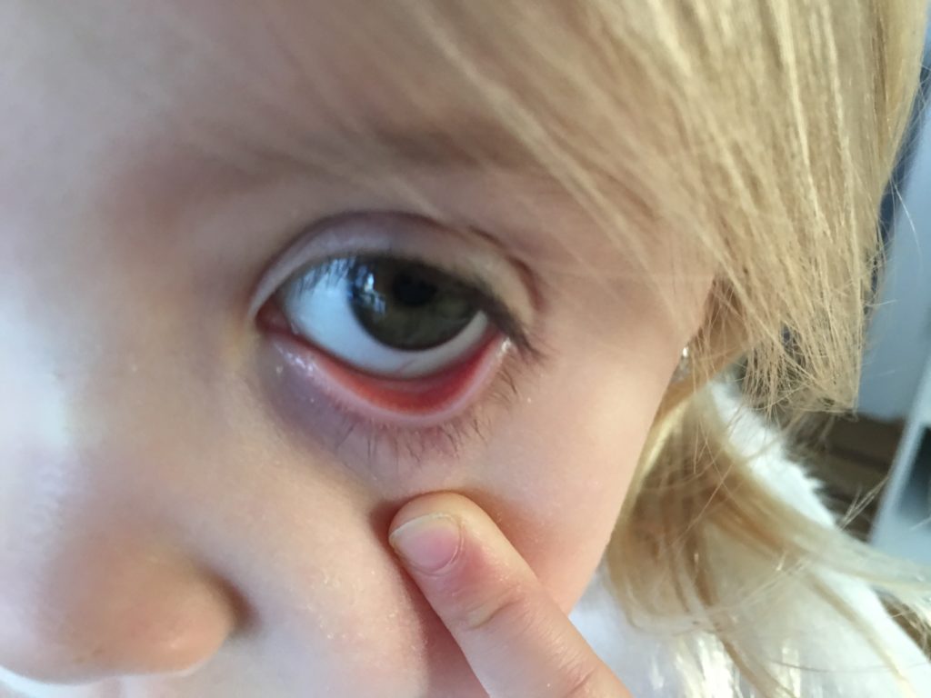 What Can Your Child s Lower Eyelids Tell You About Low Iron Levels
