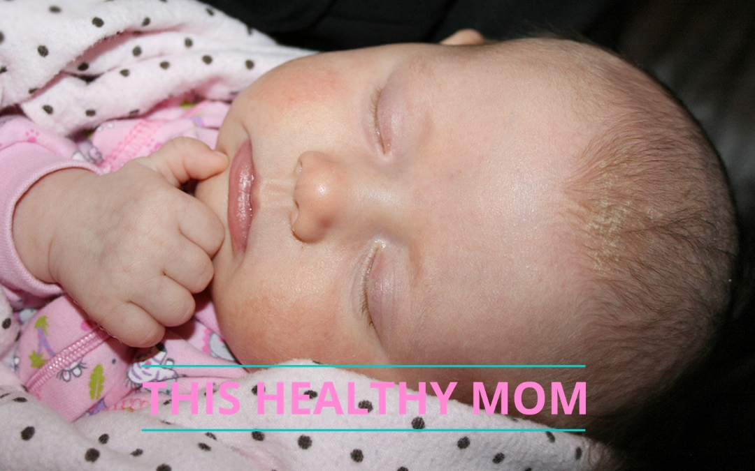 Cradle Cap Causes And Treatments This Healthy Mom